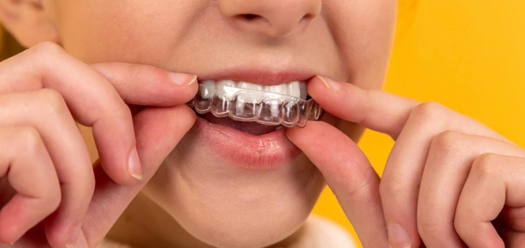 Invisalign G8: presentamos la nueva generación de aligners ...