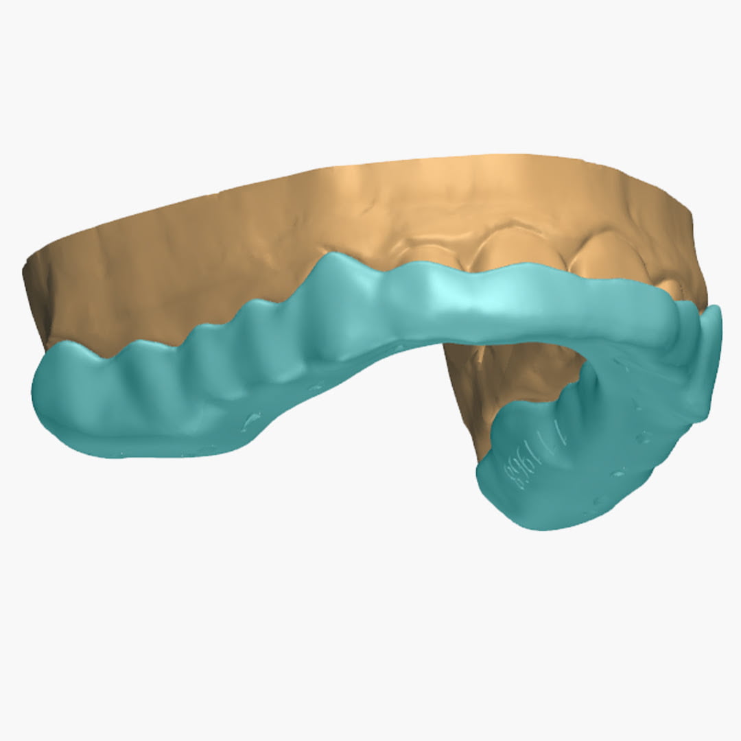¿Qué son las Férulas Michigan o férulas de descarga? | Clínica Dental ...